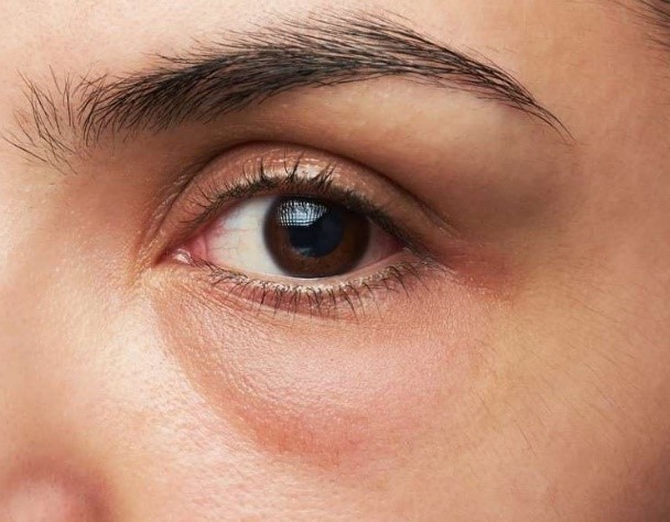 OJERAS: Tipos, causa y TRATAMIENTOS más efectivos