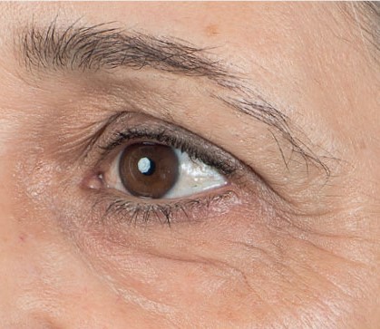 OJERAS: Tipos, causa y TRATAMIENTOS más efectivos