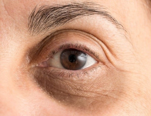 OJERAS: Tipos, causa y TRATAMIENTOS más efectivos