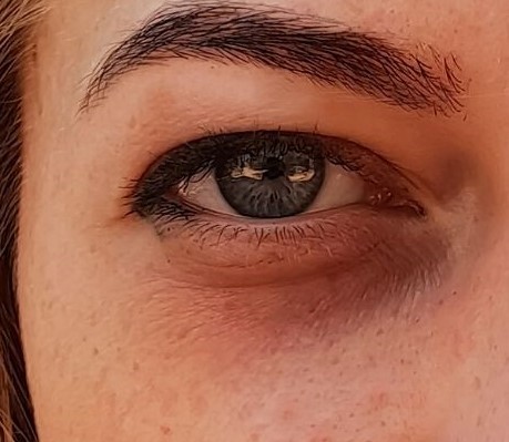 OJERAS: Tipos, causa y TRATAMIENTOS más efectivos
