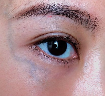 OJERAS: Tipos, causa y TRATAMIENTOS más efectivos