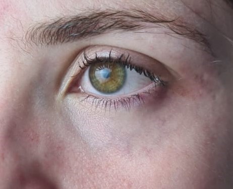 OJERAS: Tipos, causa y TRATAMIENTOS más efectivos